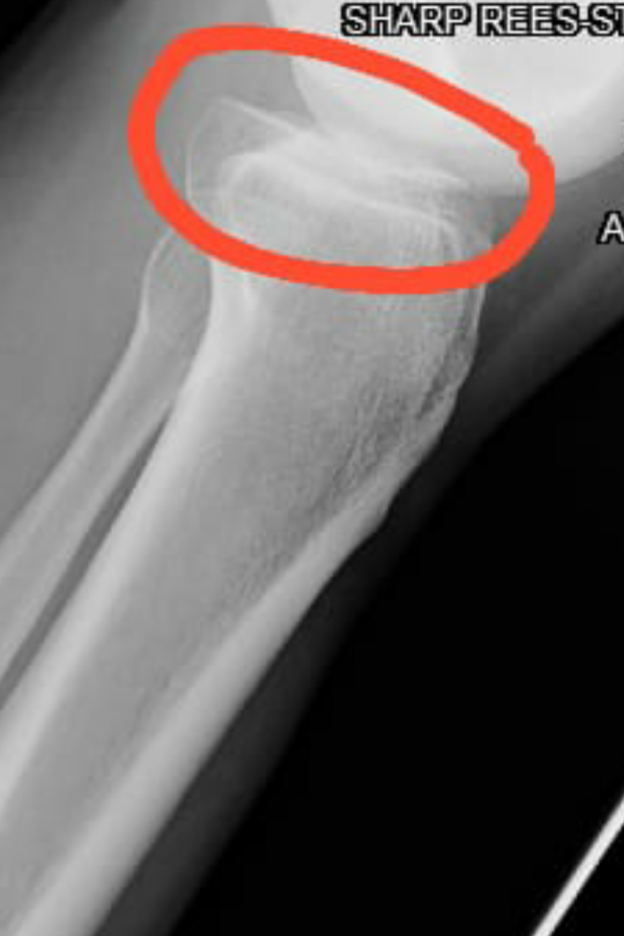 Need help evaluating x-rays | Natural Height Growth